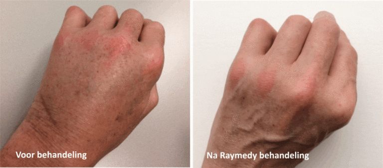 Posttraumatische dystrofie - Raymedy centrum Eindhoven